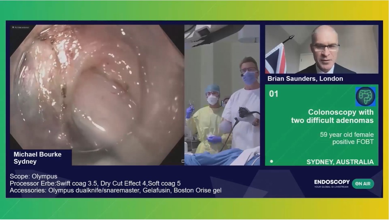 Colon EMR and ESD, Part 2 - Endoscopy On Air