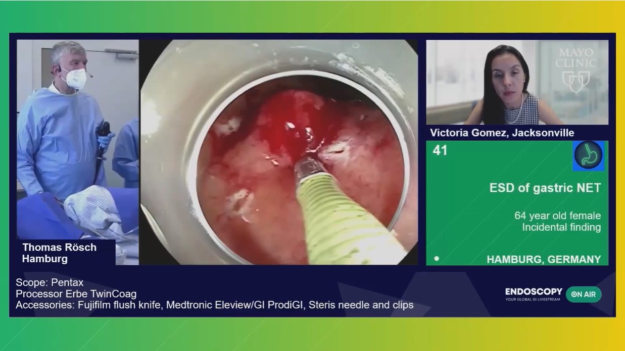 ESD of gastric NET - Endoscopy On Air