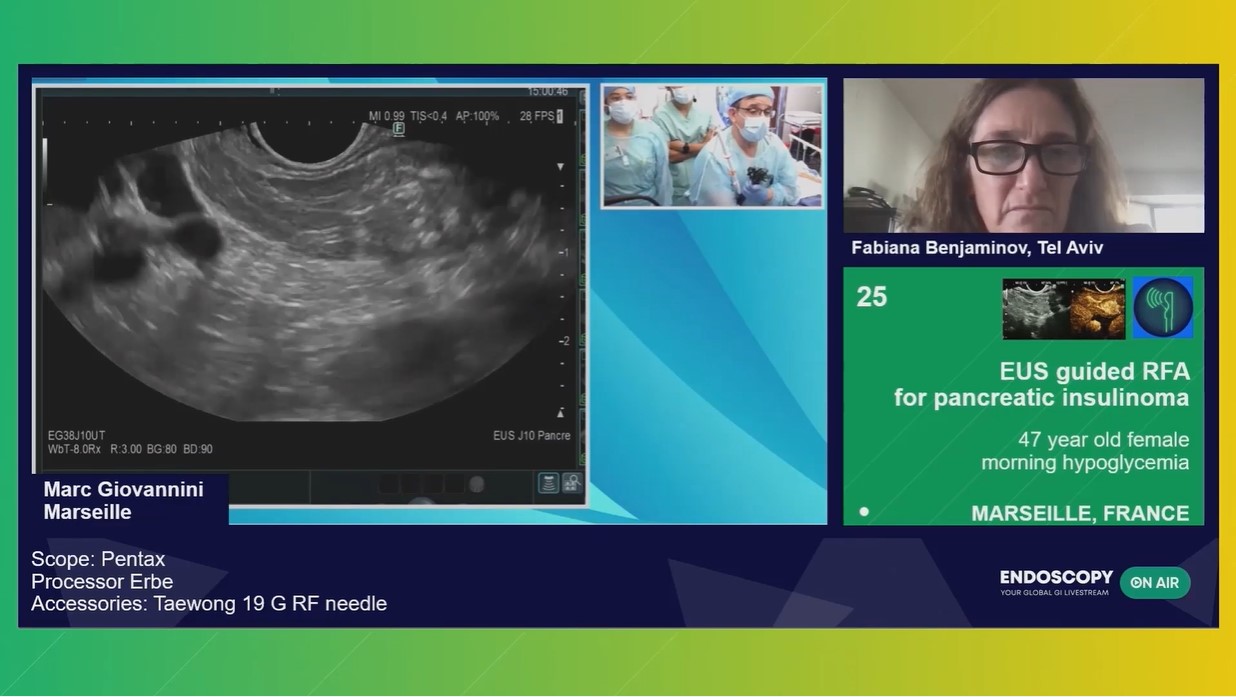 EUS guided RFA for pancreatic insulinoma - Endoscopy On Air