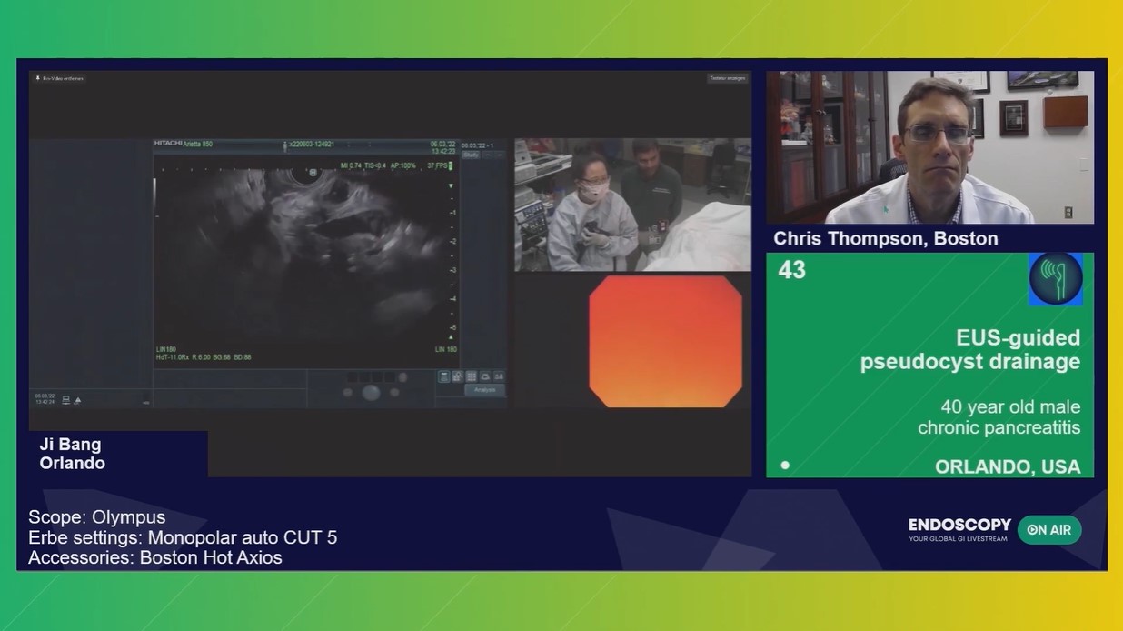 EUS-guided biliary drainage - Endoscopy On Air