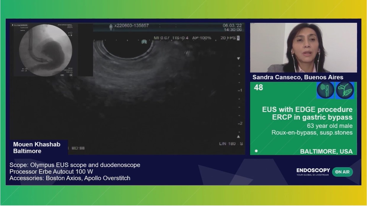 EUS with EDGE procedure ERCP in gastric bypass - Endoscopy On Air