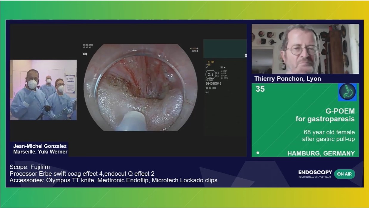G POEM for gastroparesis - Endoscopy On Air
