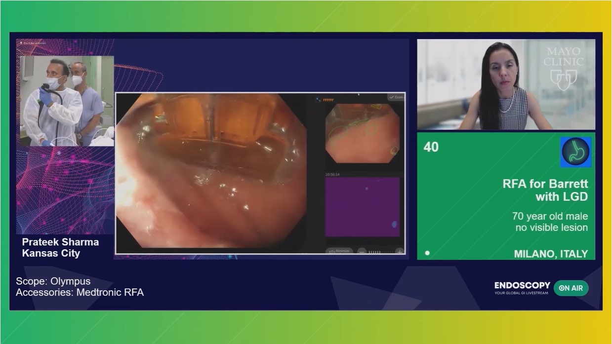 RFA for Barrett with LGD, Part 2 - Endoscopy On Air