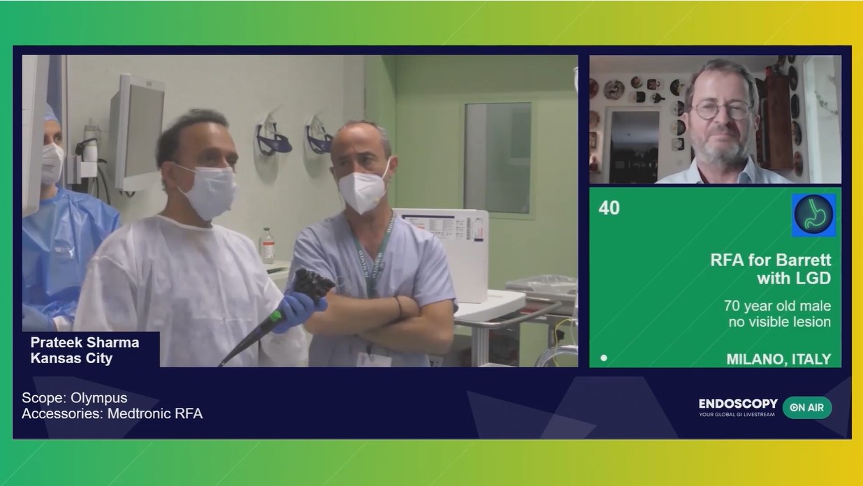 RFA for Barrett with LGD - Endoscopy On Air