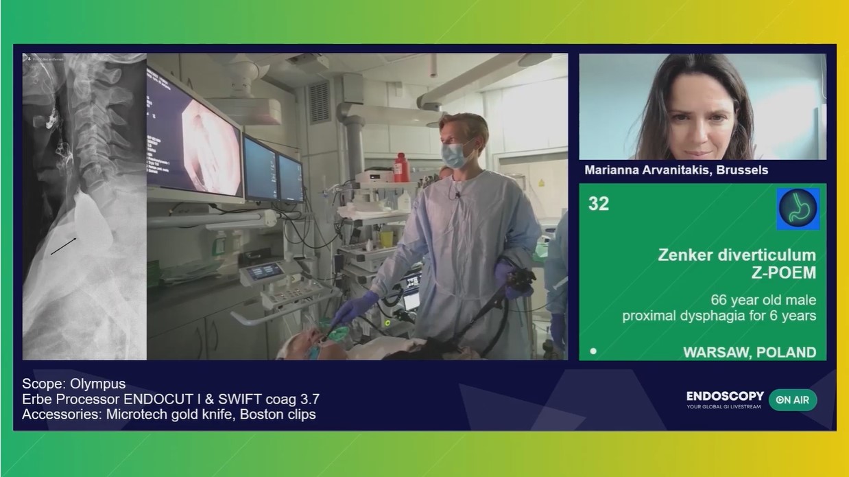 Z-POEM - Endoscopy On Air