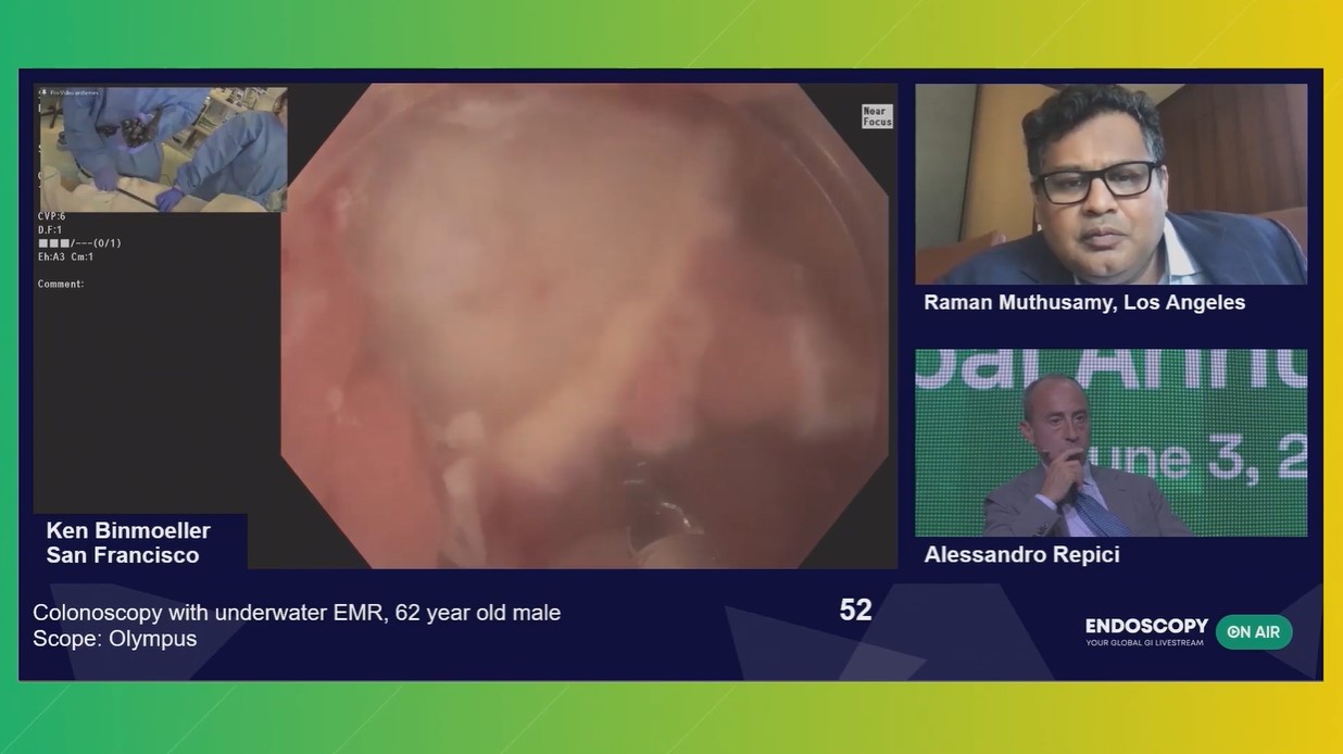 Colonic underwater EMR - Endoscopy On Air