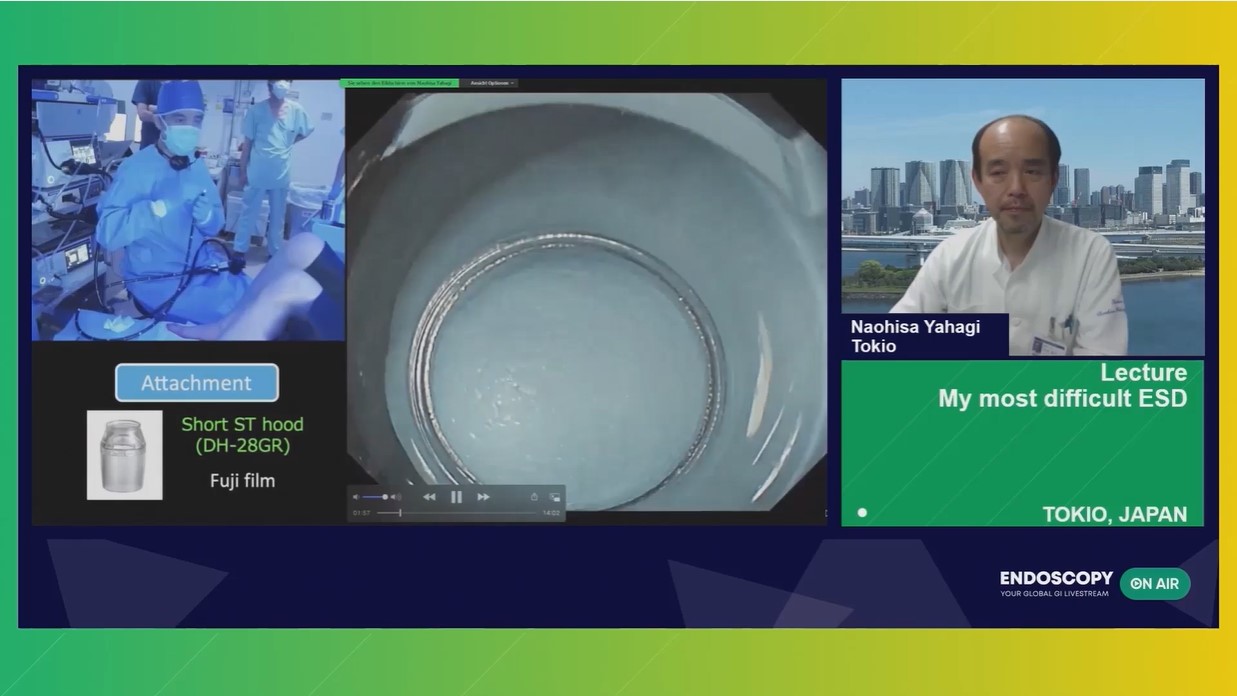 My most difficult POEM - Endoscopy On Air