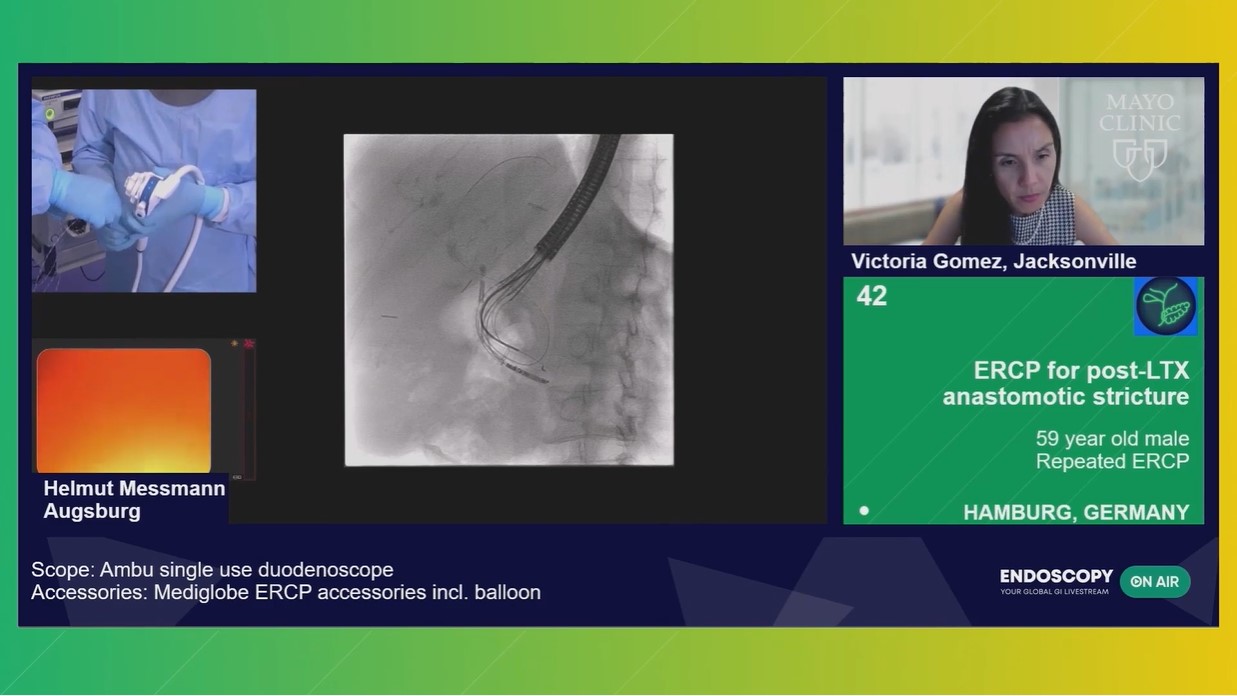 Single use ERCP - Endoscopy On Air