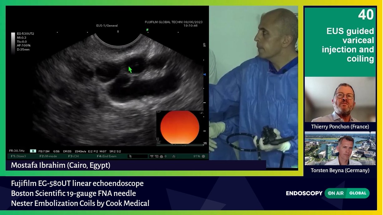 EUS guided variceal injection and coiling - Mostafa Ibrahim - Endoscopy ...