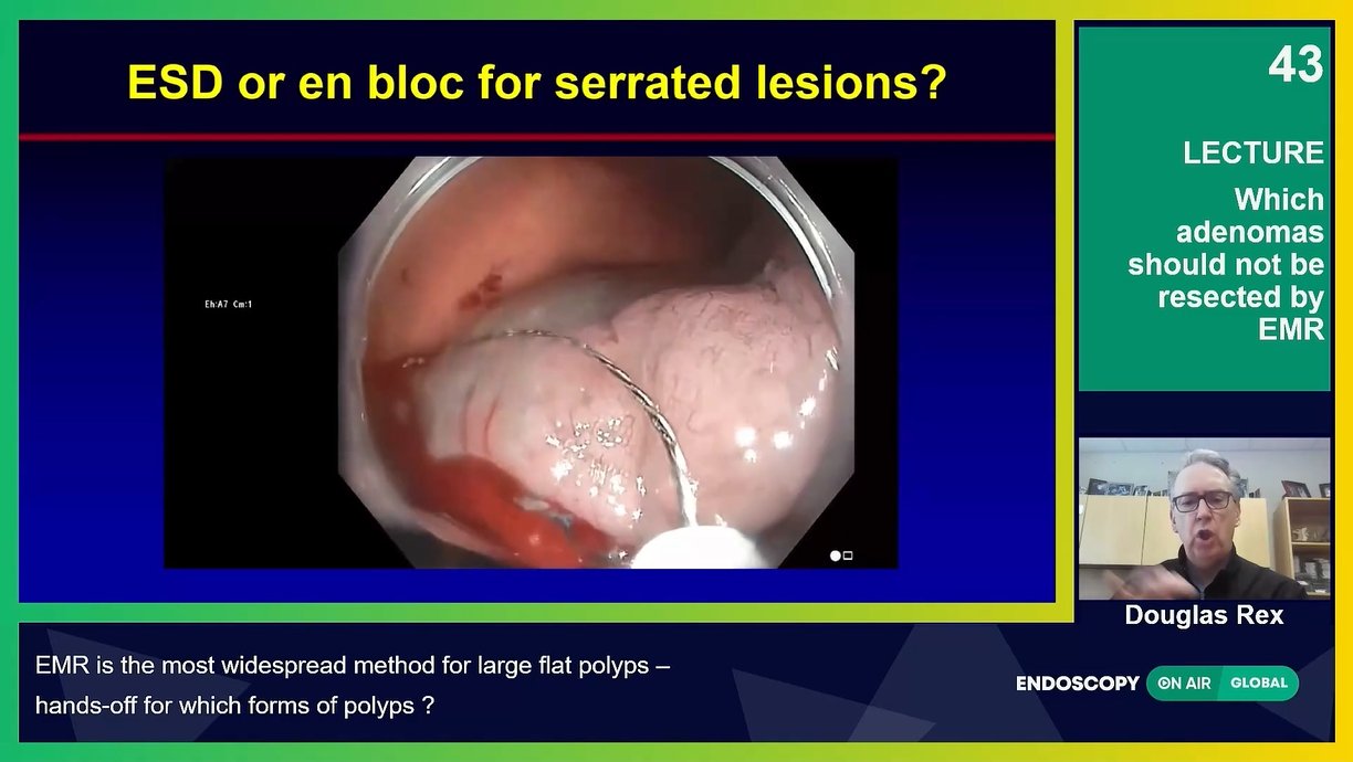 When not to do EMR - Douglas Rex - Endoscopy On Air